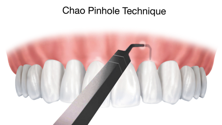 Arizona Periodontal Group Offers the Pinhole Surgical Technique ...
